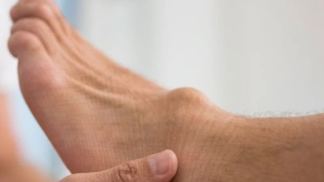 L’image impressionnante du pied de Rafael Nadal ravagé par une maladie ...