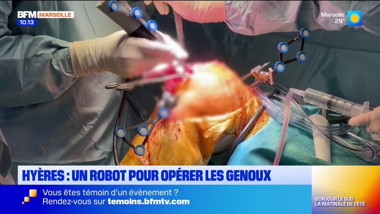 Hyères: un robot pour opérer les genoux à l'hôpital René Sabran