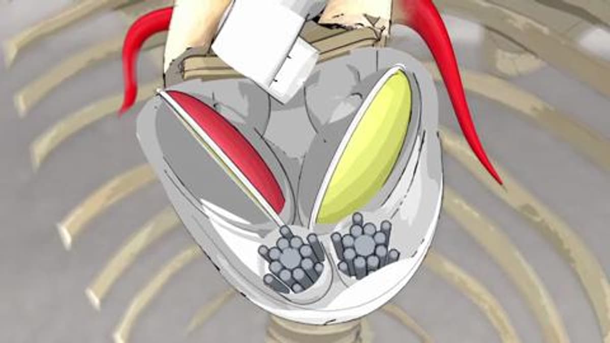 Comment fonctionne le cœur artificiel Carmat