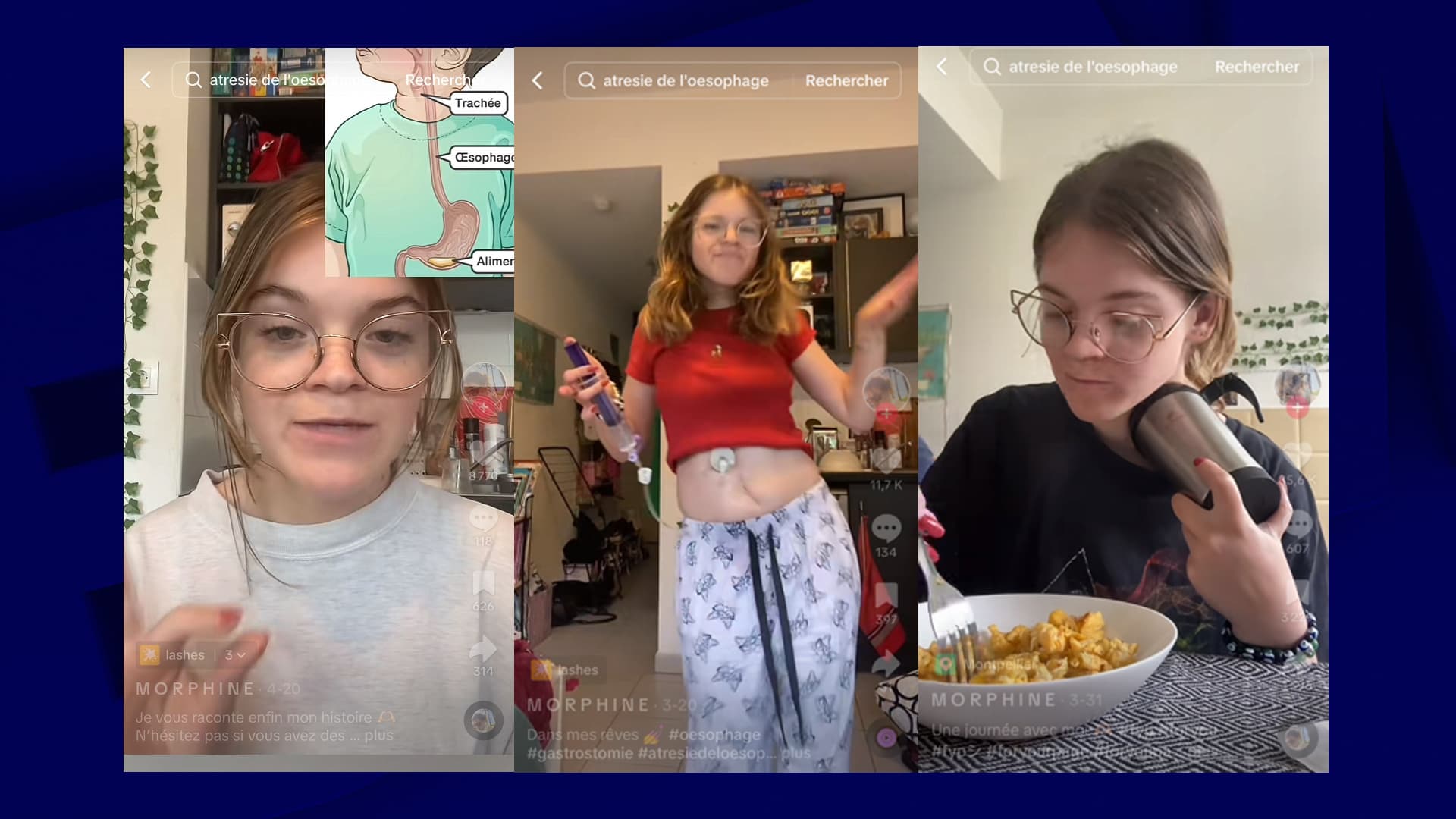 "J'ai la joie de vivre": Eva, 19 ans, vit sans œsophage depuis 10 ans après une malformation de ...