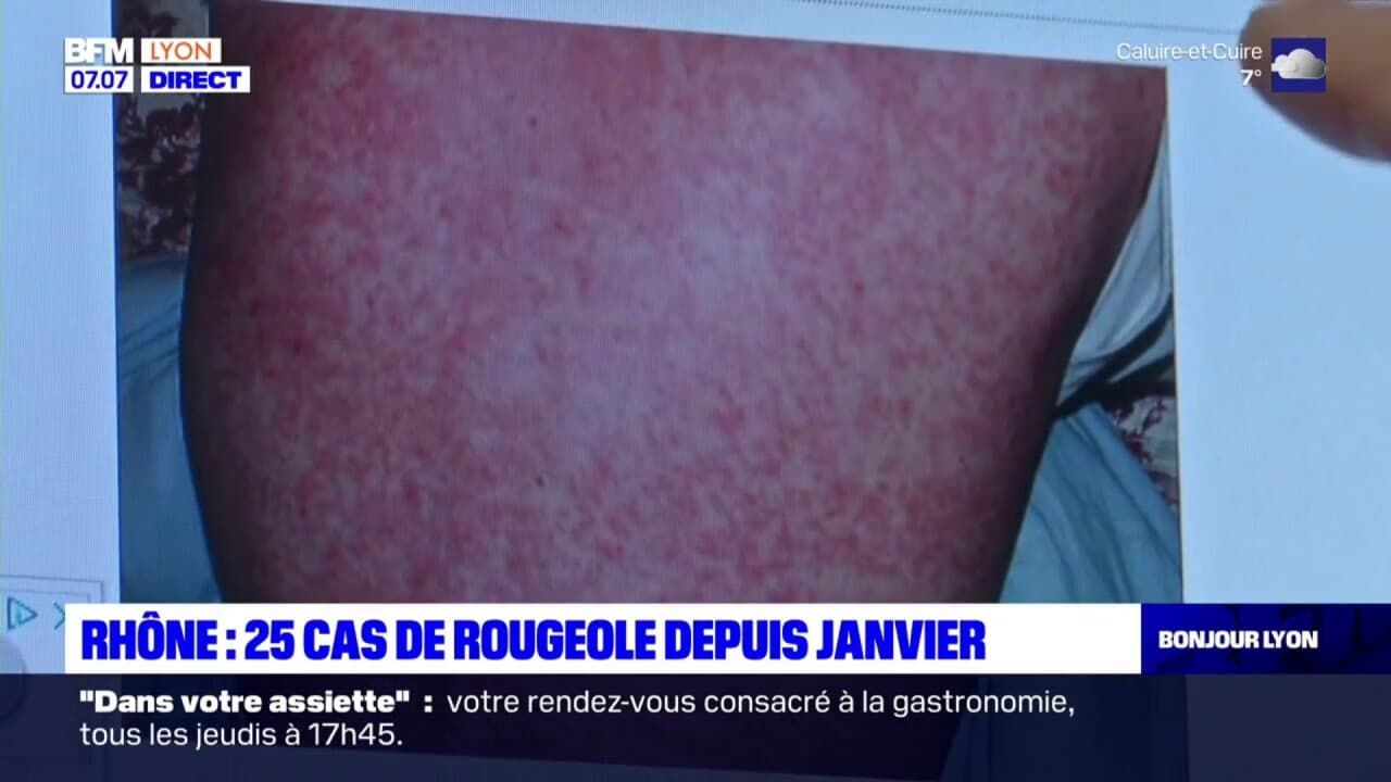 Rhône: 25 cas de rougeole recensés depuis le début du mois de janvier