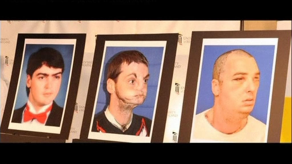 Médecine : des chirurgiens réalisent la 1ere greffe complète du visage